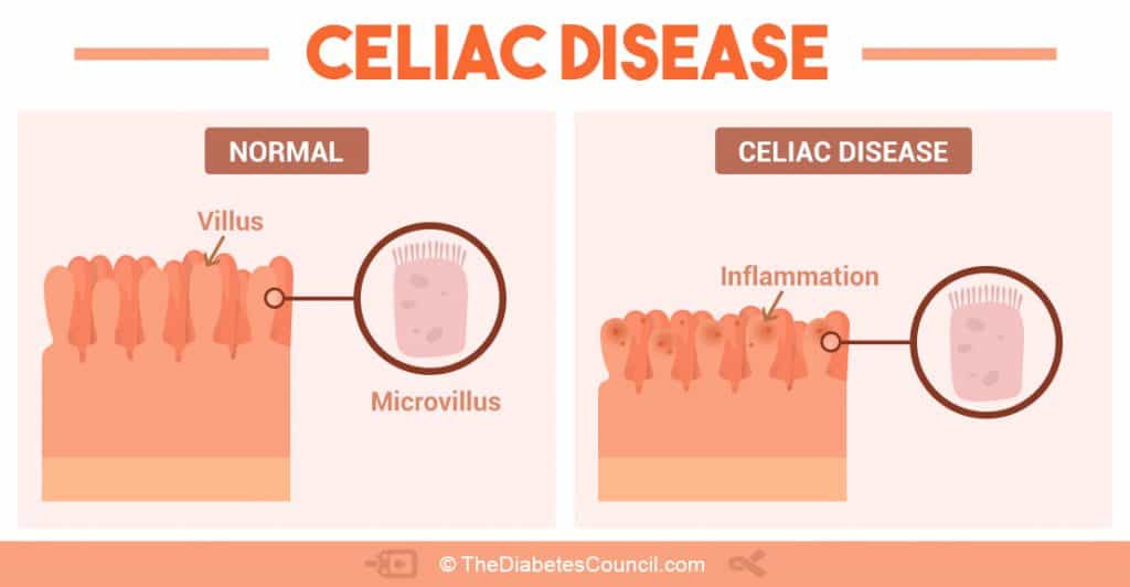 Balancing Diabetes and Celiac Disease